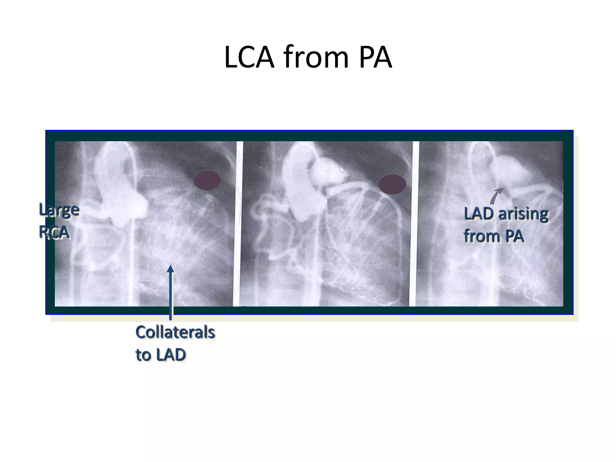 Coronary anatomy and angiographic views | PPTX