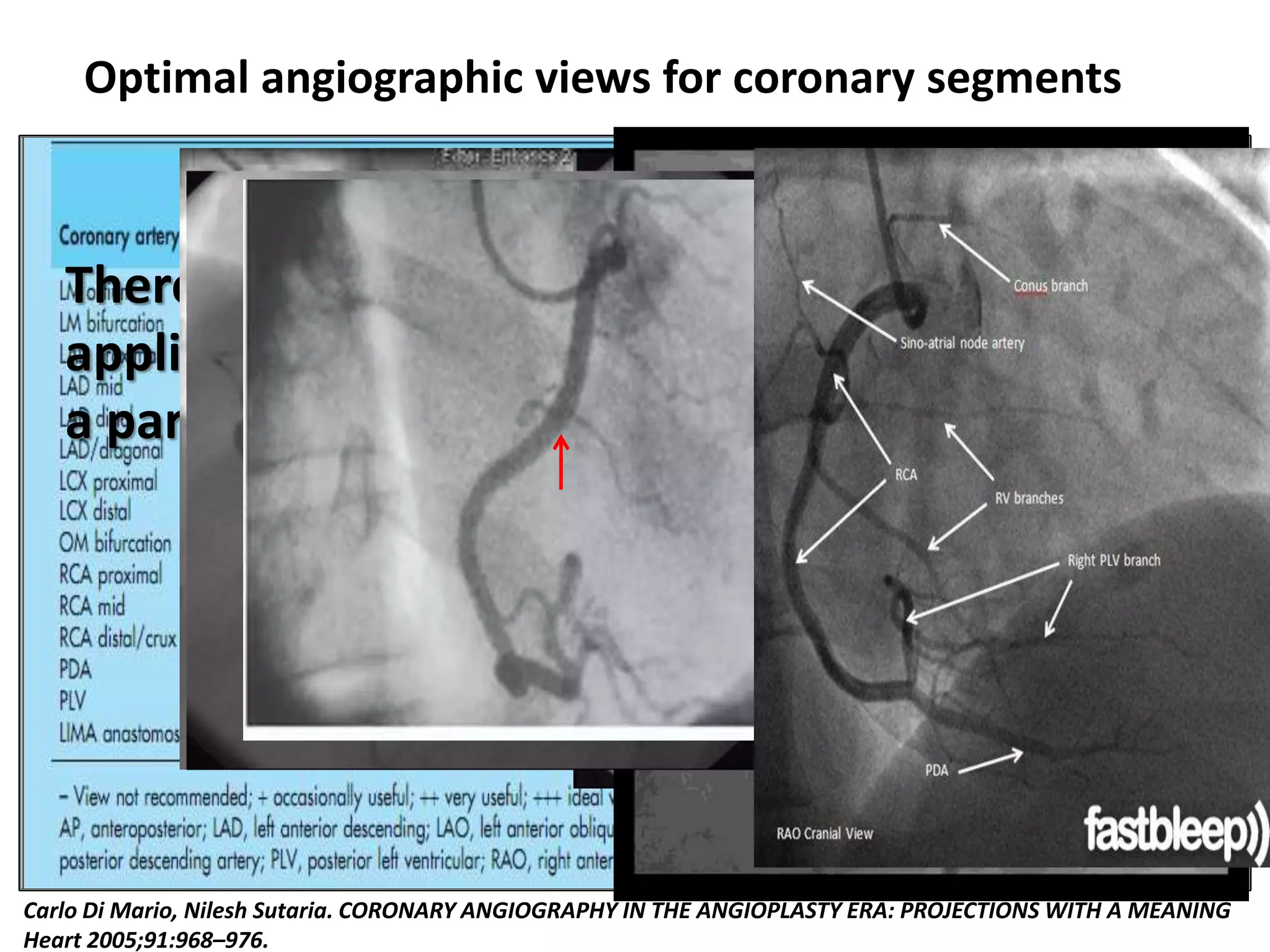 Coronary anatomy and angiographic views | PPTX