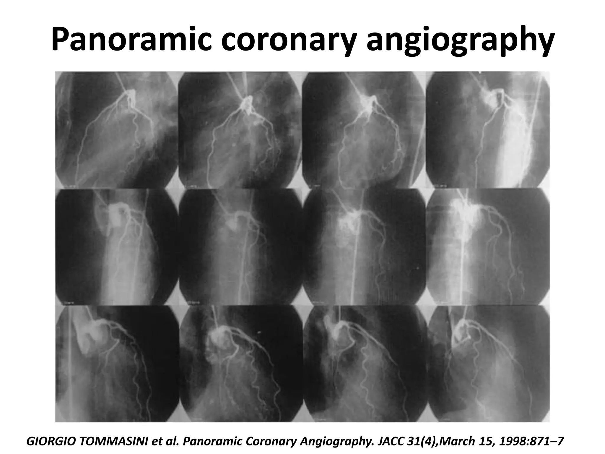 Coronary anatomy and angiographic views | PPTX