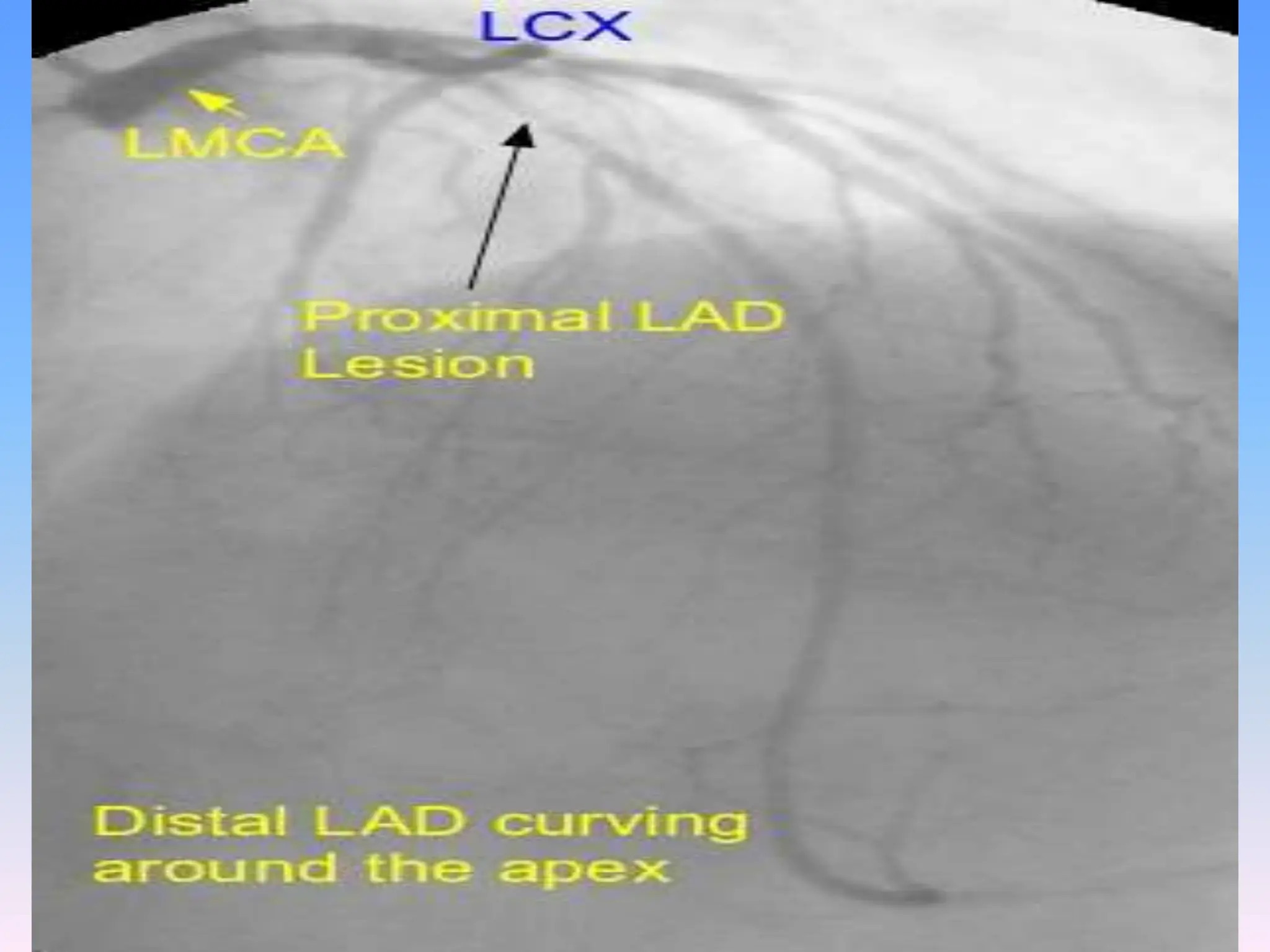 CORONARY ANATOMY _ SANDEEP M CAG VIEWS.ppsx