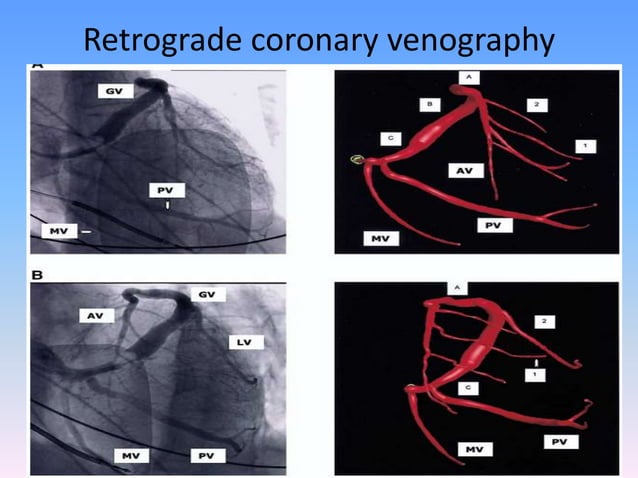 CORONARY ANATOMY _ SANDEEP M CAG VIEWS.ppsx | Heart and Cardiovascular ...