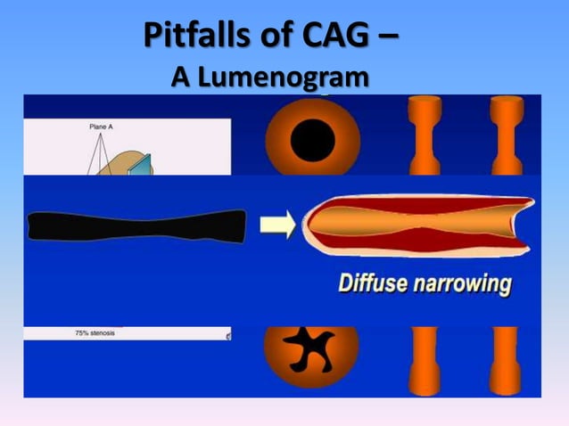 CORONARY ANATOMY _ SANDEEP M CAG VIEWS.ppsx | Heart and Cardiovascular ...