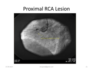 Coronary angiogram an overview | PPT
