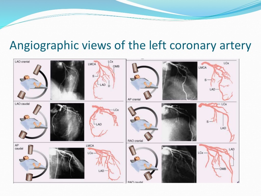 Coronary angiography
