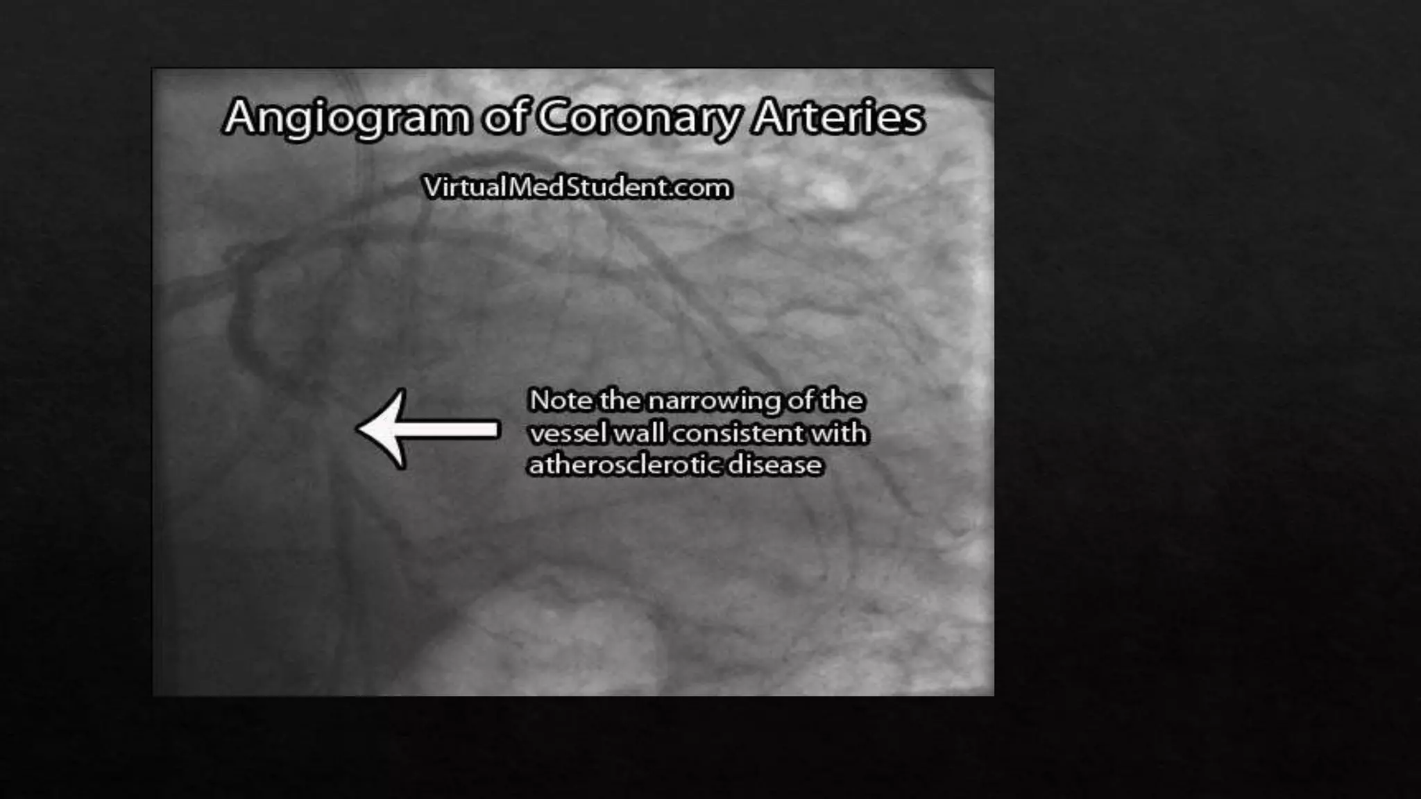 Coronary angiography | PPT