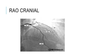 Coronary angiography | PPTX