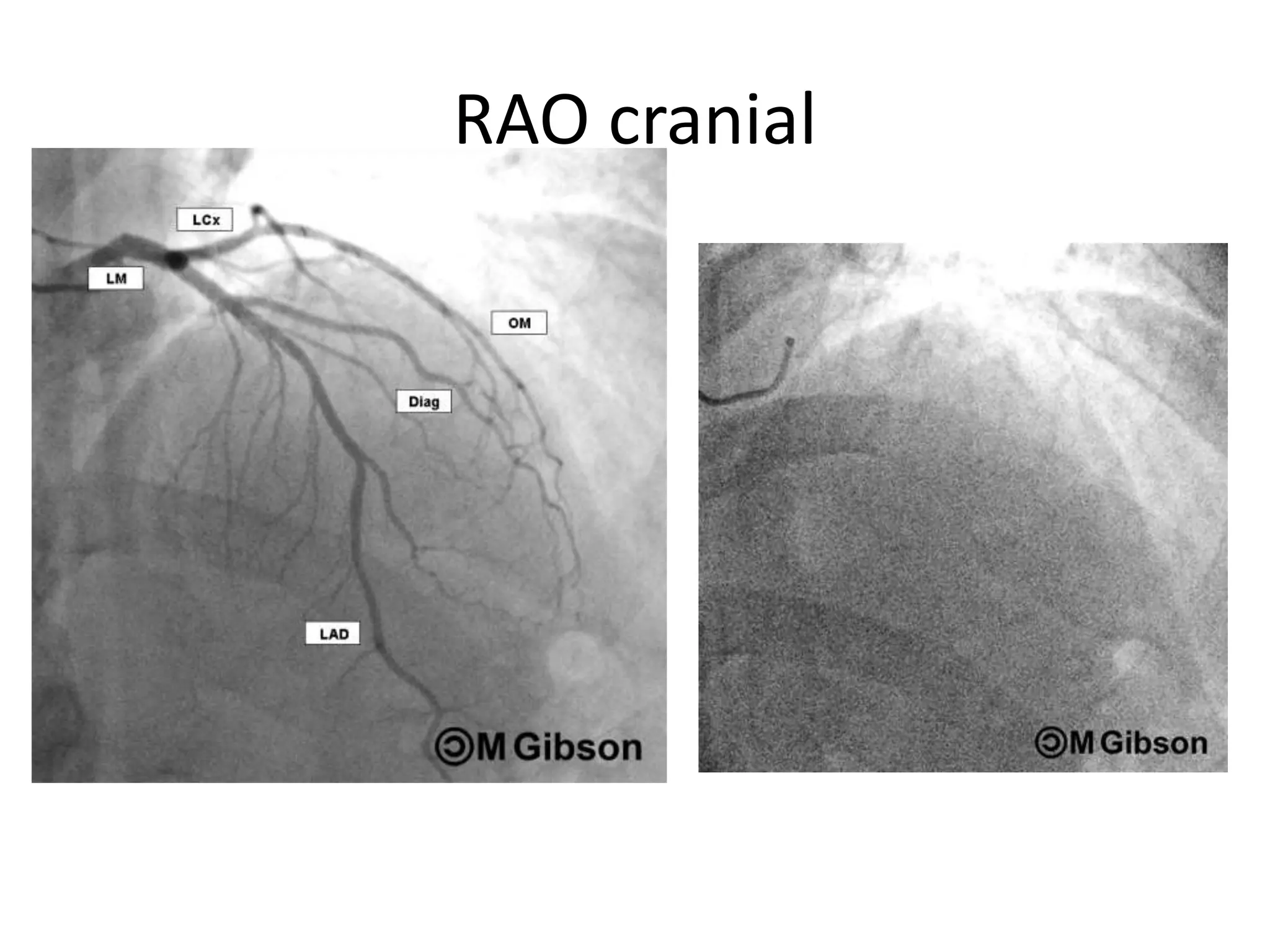 coronaryangiography-220330142539 (1).pdf