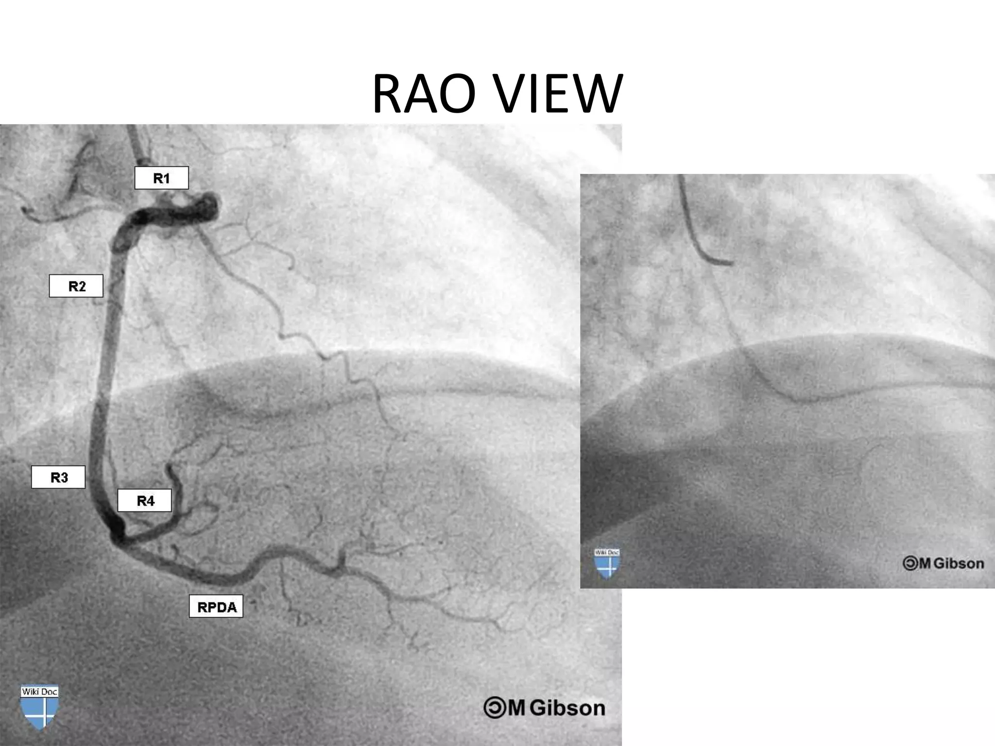 coronaryangiography-220330142539 (1).pdf