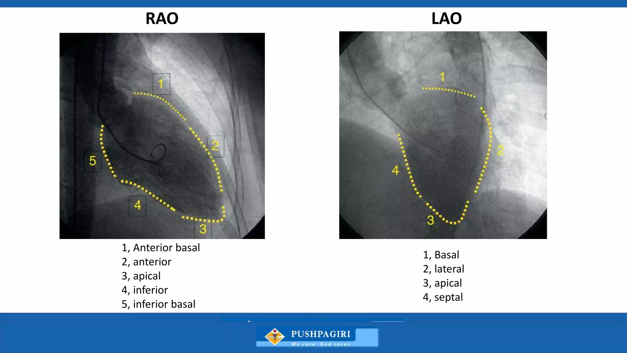 Coronary Angiography - Views - Dr Hafeesh Fazulu - PIMS.pptx