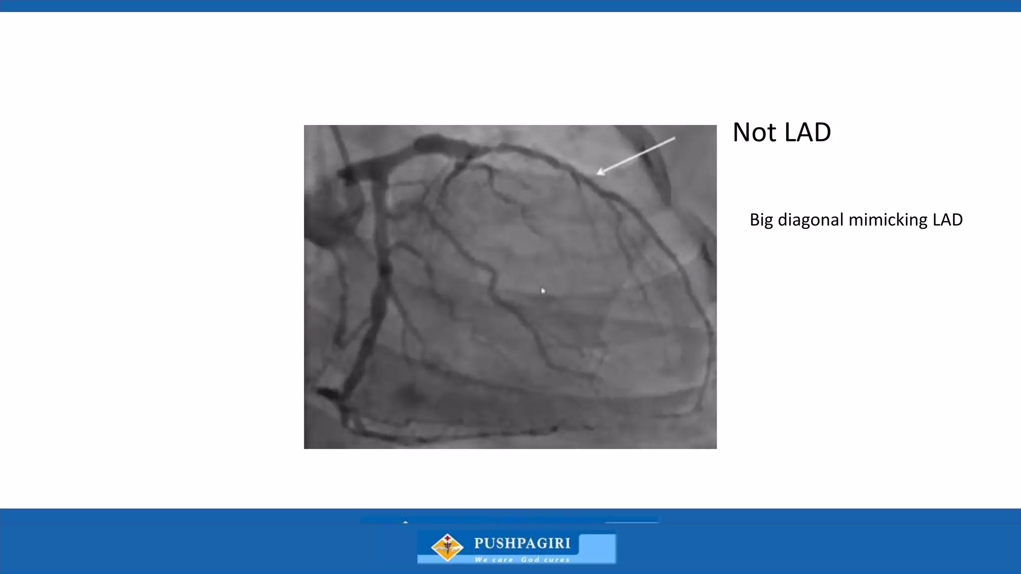 Coronary Angiography - Views - Dr Hafeesh Fazulu - PIMS.pptx