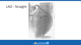 Coronary Angiography - Views - Dr Hafeesh Fazulu - PIMS.pptx