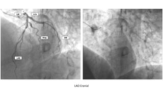 CORONARY ANGIOGRAPHY INTERPRET(Coronary Angios).pptx