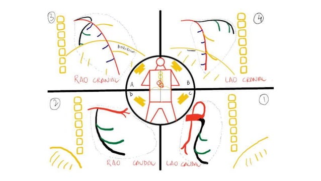 Coronary Angiography Interpret Coronary Angios Pptx