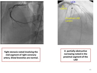Coronary angiography | PPTX