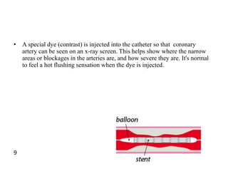 Coronary angioplasty (1) | PPTX