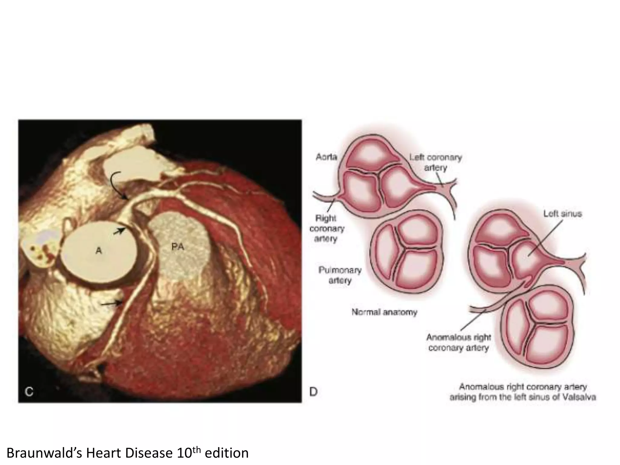 Coronary arteries anomalies | PPTX