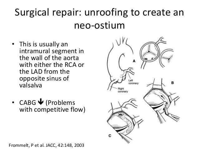 Coronary arteries anomalies