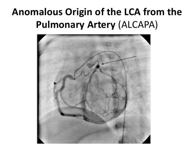 Coronary arteries anomalies