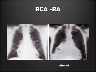 Coronary arterio venous fistula | PPT | Heart and Cardiovascular ...