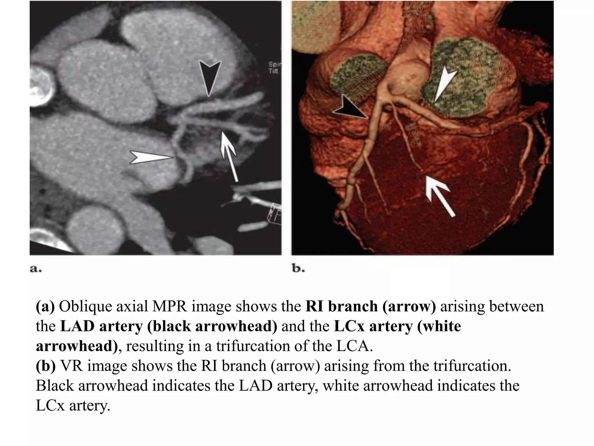 Coronary artery anatomy | PPTX