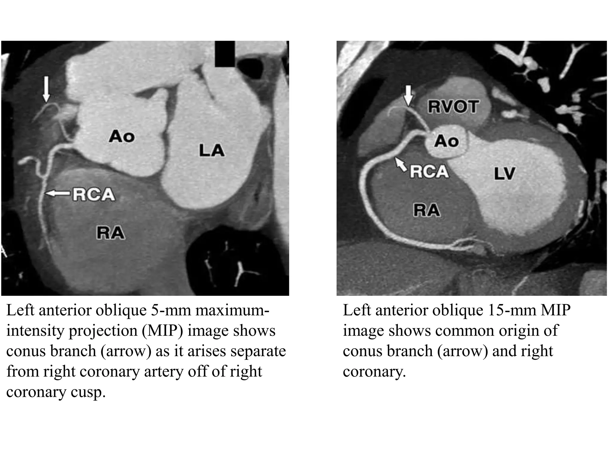 Coronary artery anatomy | PPTX