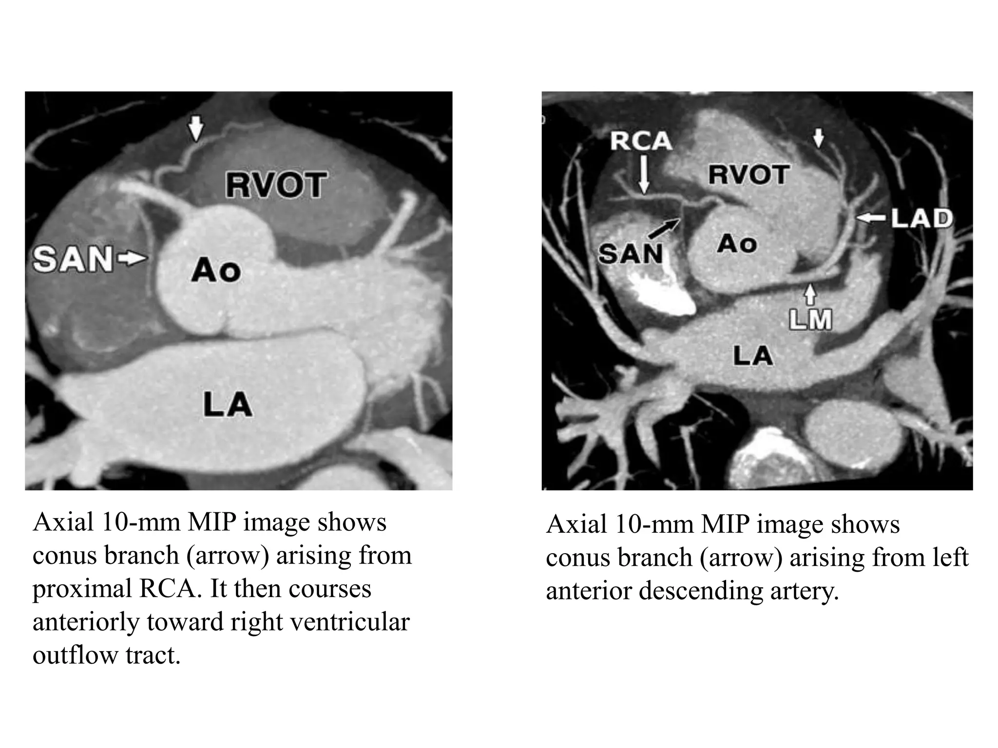 Coronary artery anatomy | PPTX