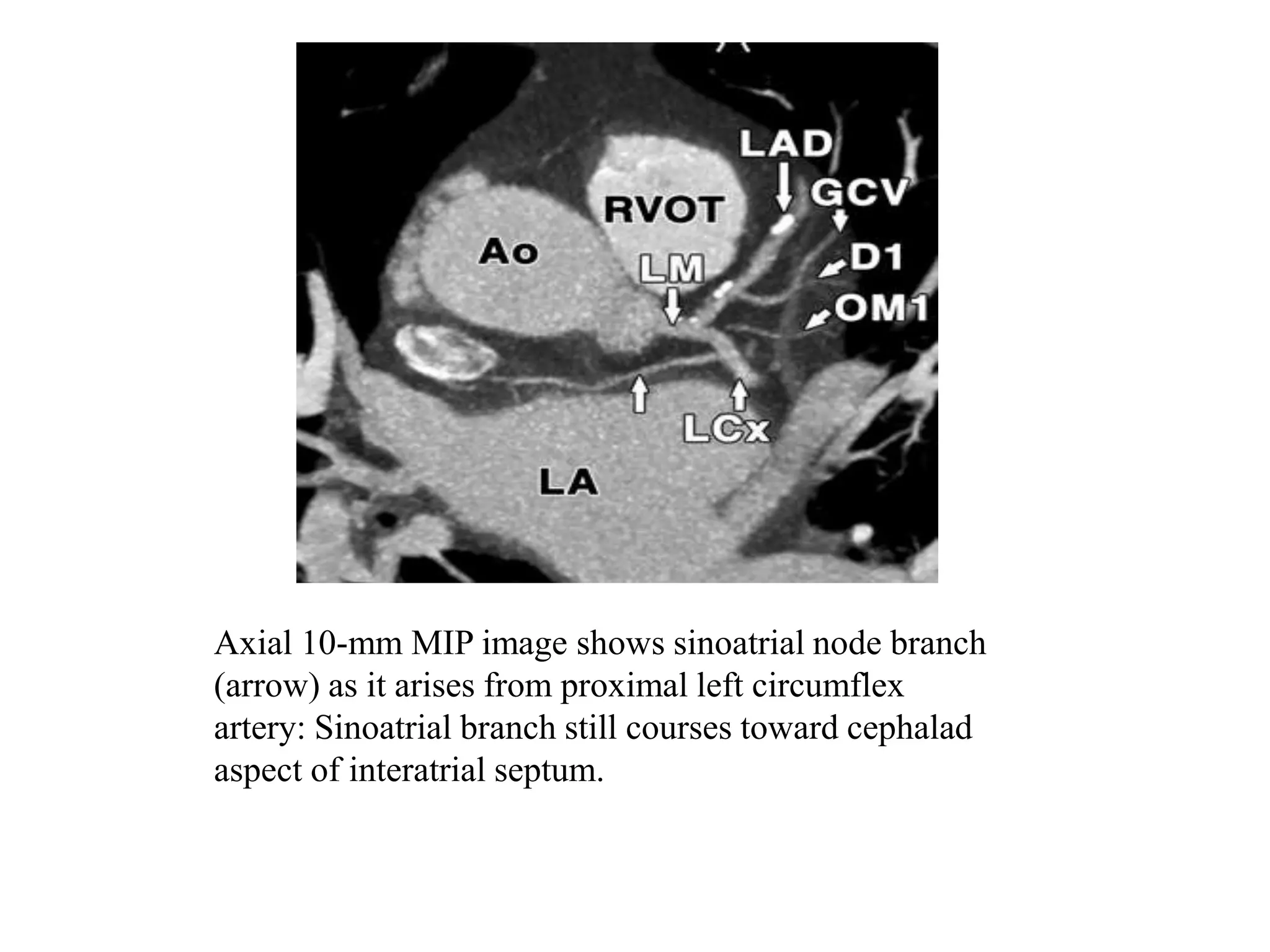 Coronary artery anatomy | PPTX