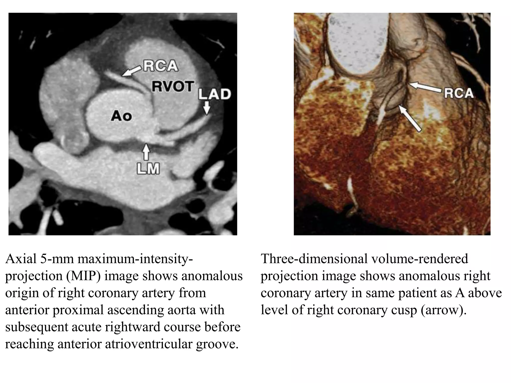 Coronary artery anatomy | PPTX