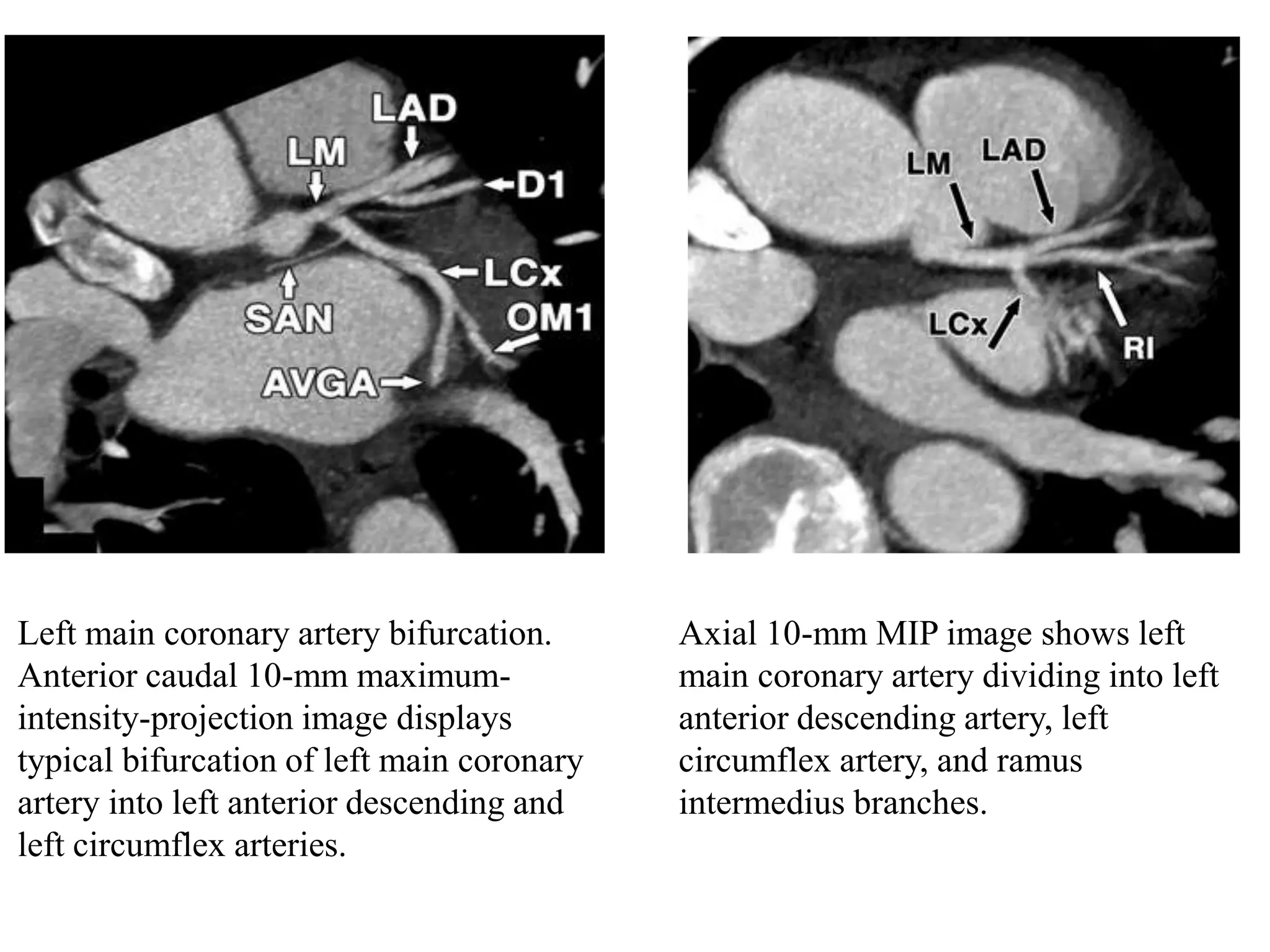 Coronary artery anatomy | PPTX