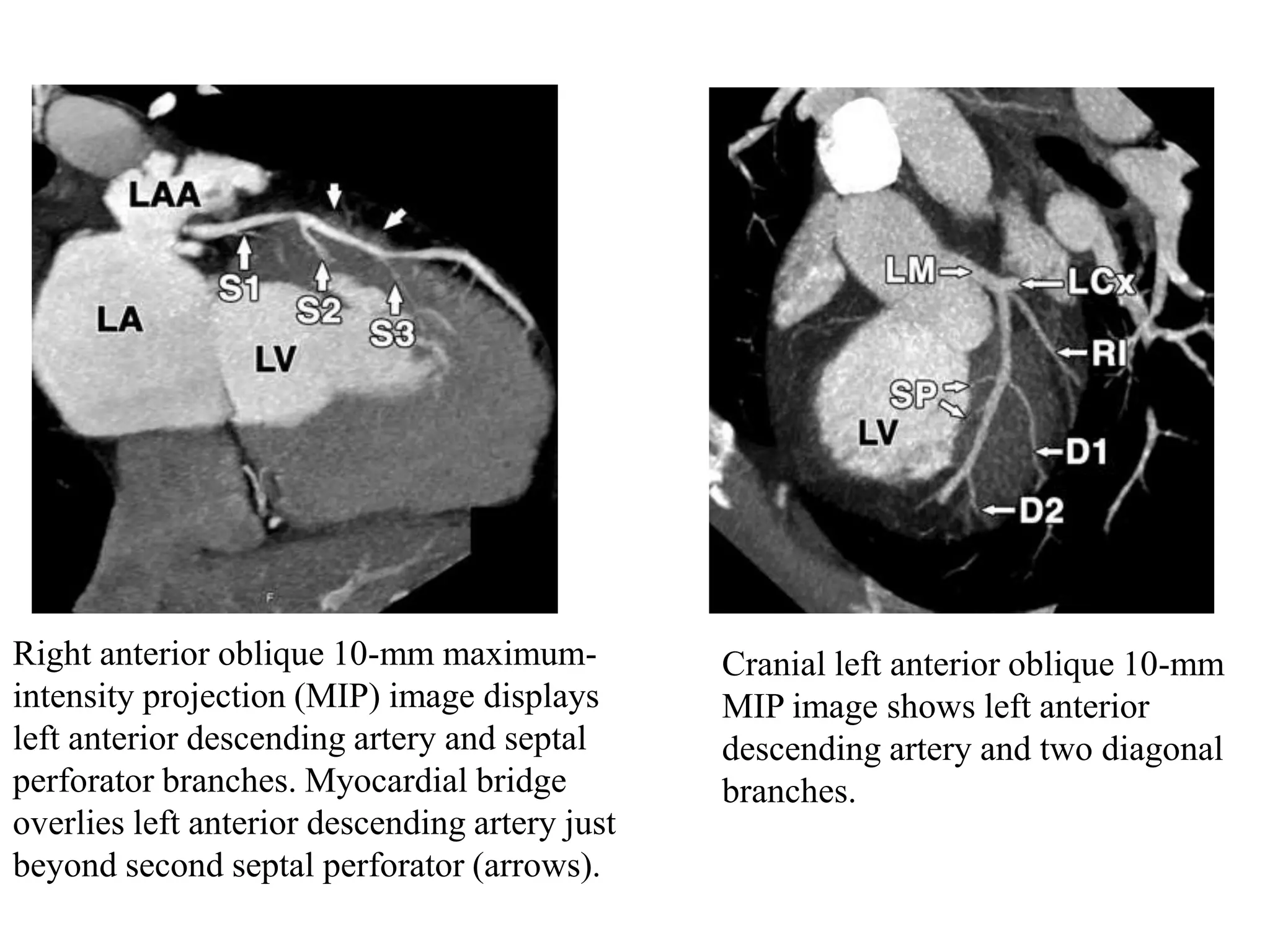 Coronary artery anatomy | PPTX