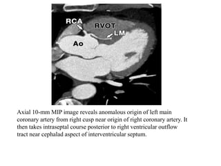 Coronary artery anatomy | PPTX