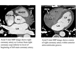 Coronary artery anatomy | PPTX