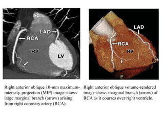Coronary artery anatomy | PPTX