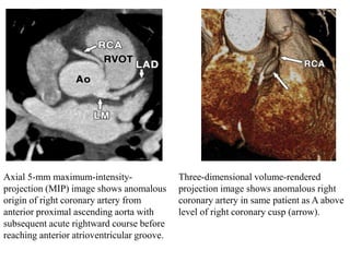 Coronary artery anatomy | PPTX
