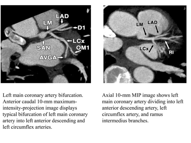 Coronary artery anatomy | PPTX