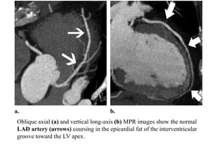 Coronary artery anatomy | PPTX