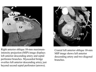 Coronary artery anatomy | PPTX