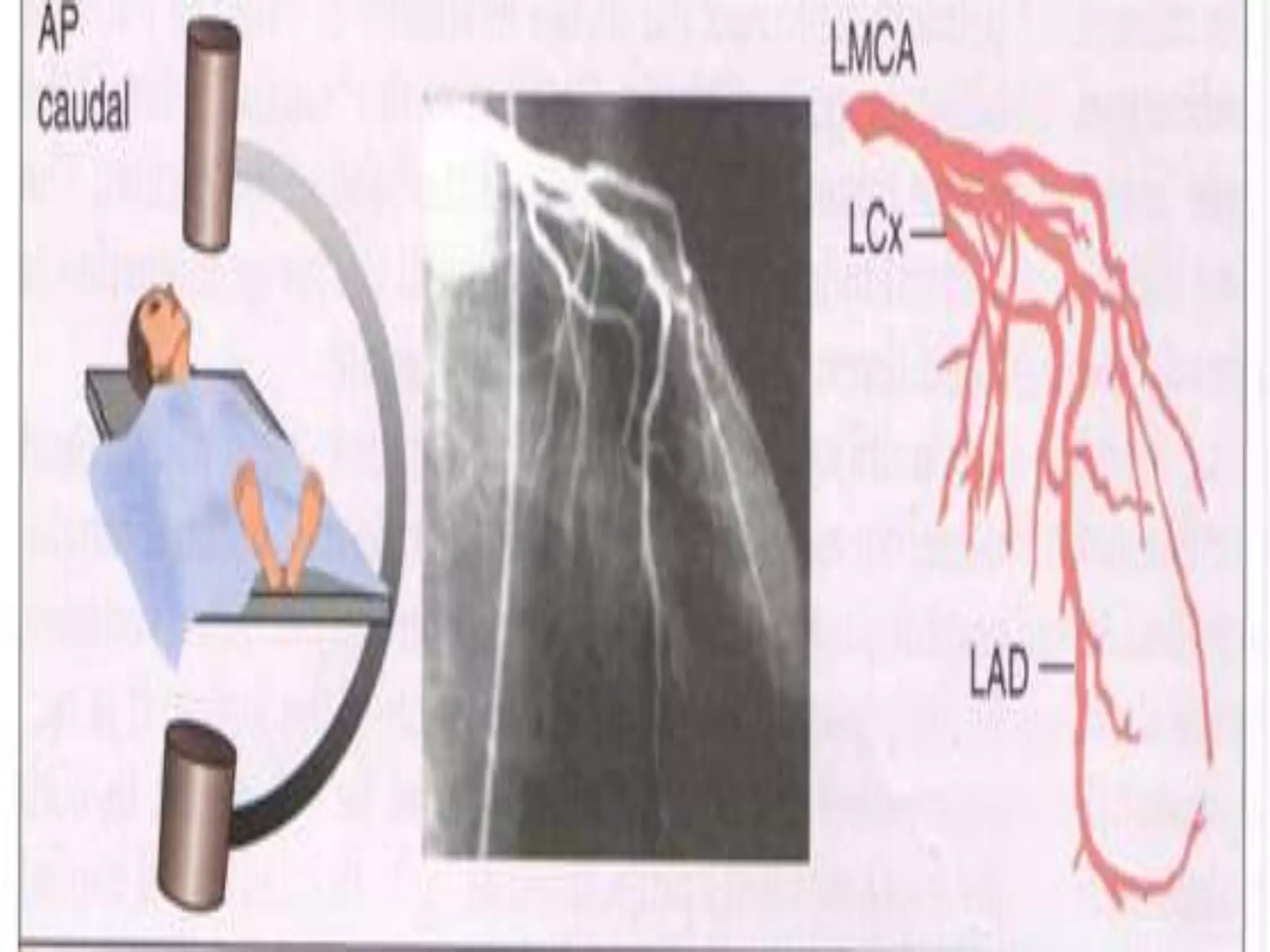 coronary artery angiography.ppt