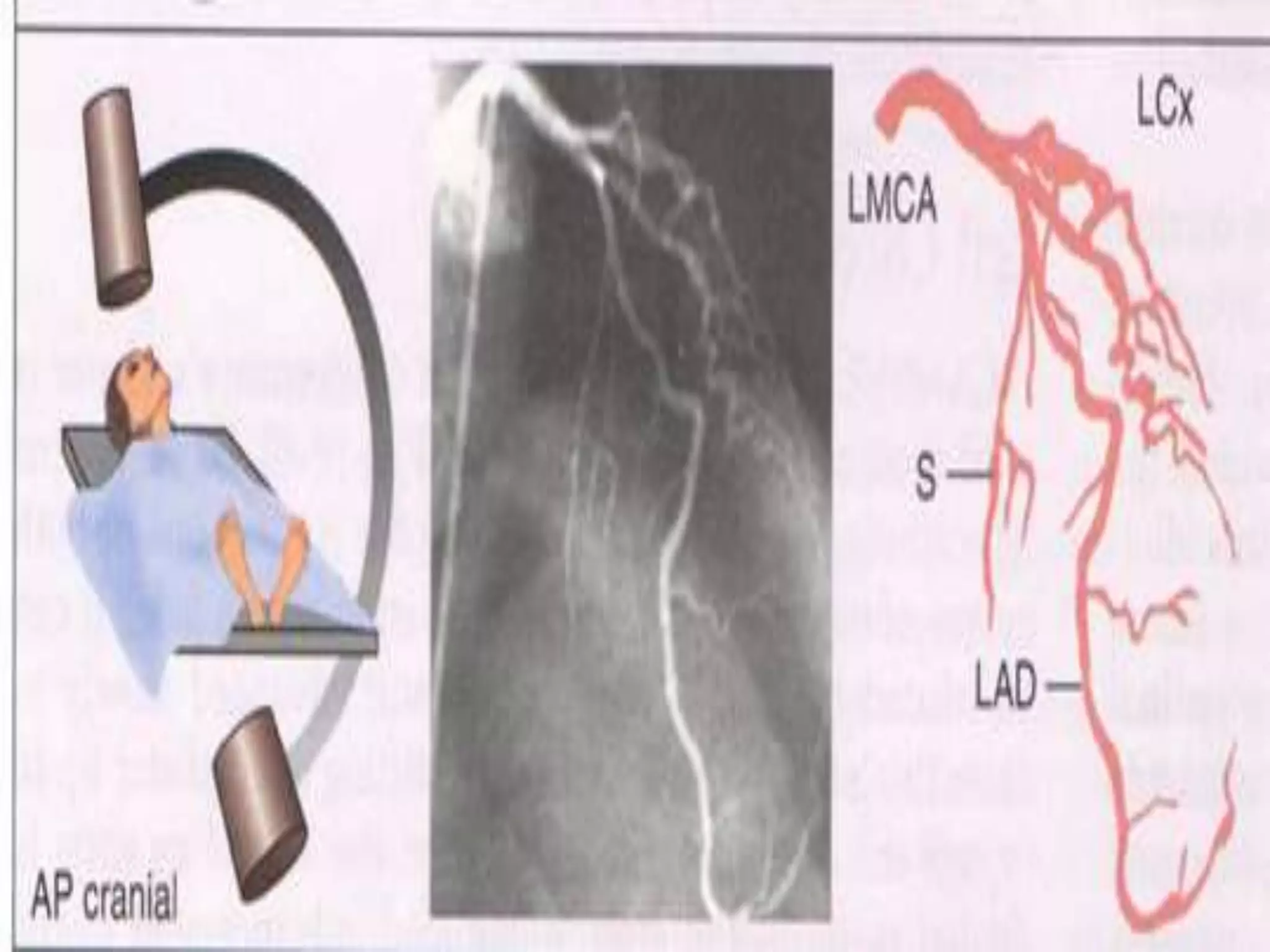 coronary artery angiography.ppt