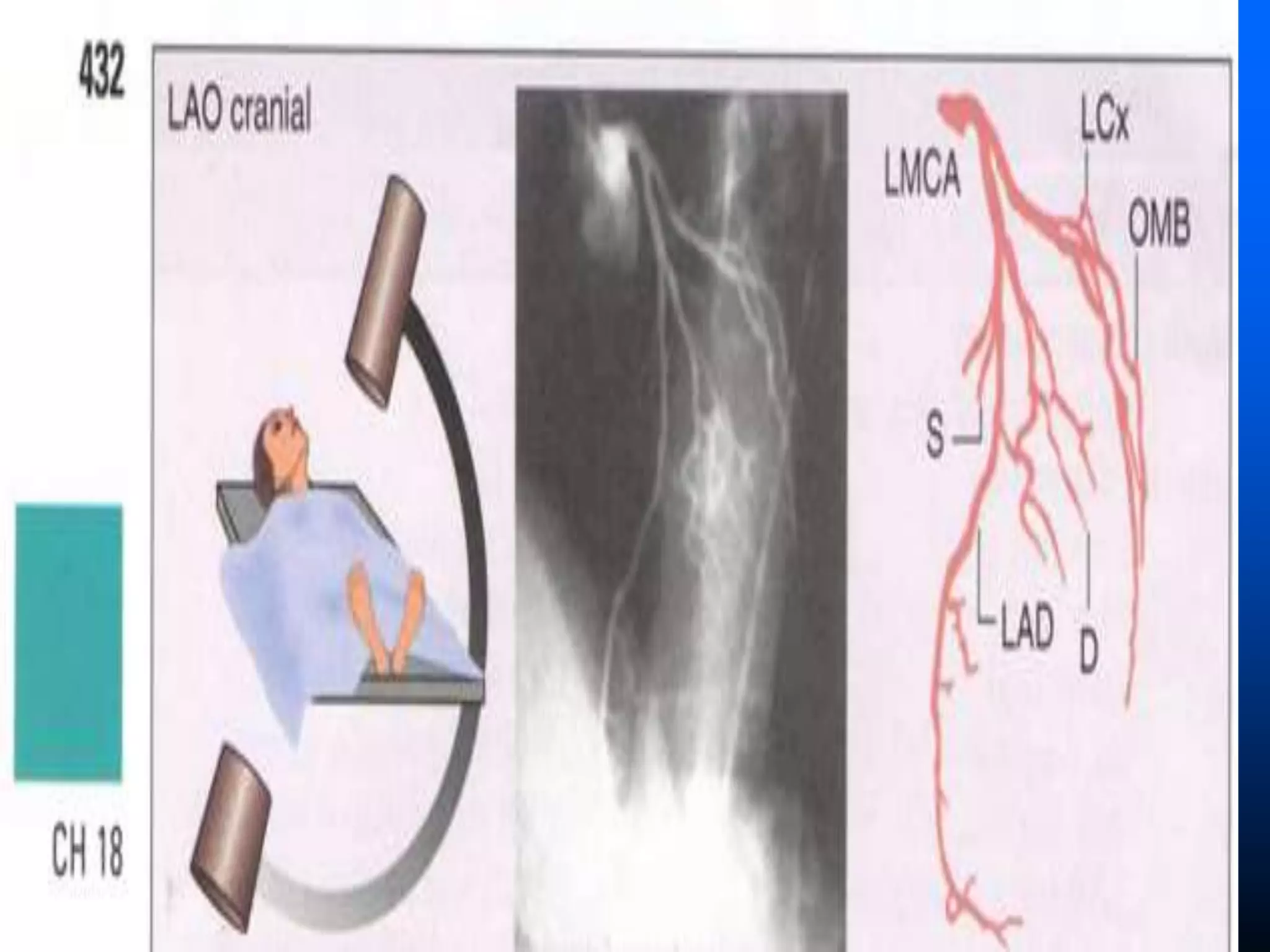 coronary artery angiography.ppt