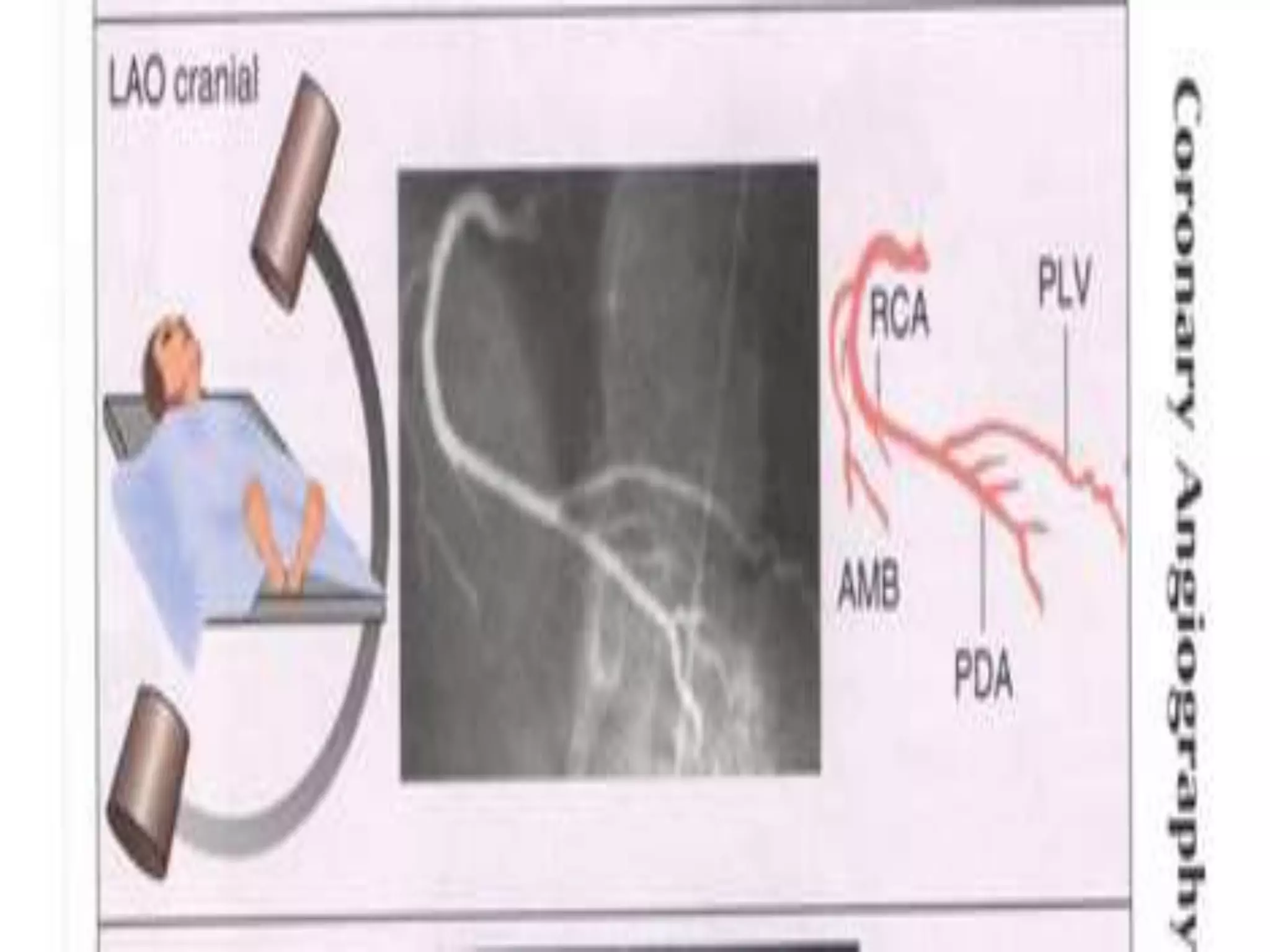 coronary artery angiography.ppt