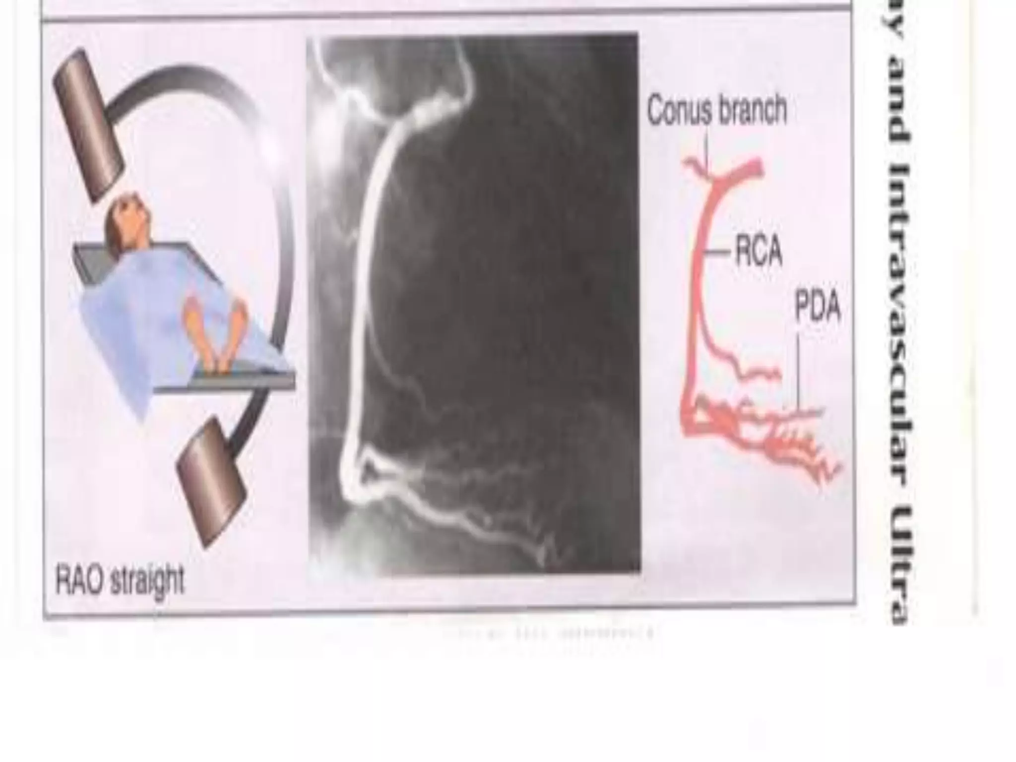 coronary artery angiography.ppt