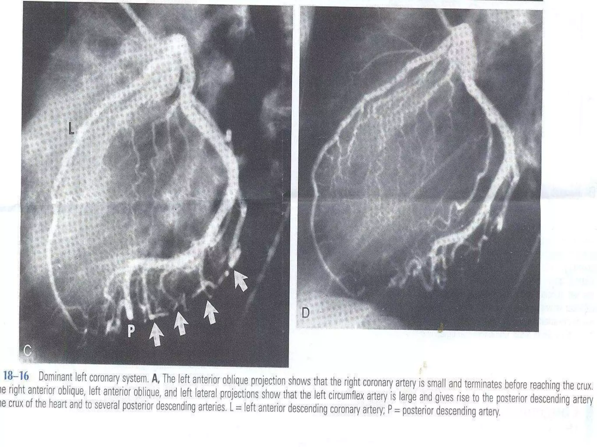 coronary artery angiography.ppt