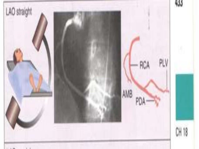 coronary artery angiography.ppt