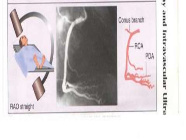 coronary artery angiography.ppt