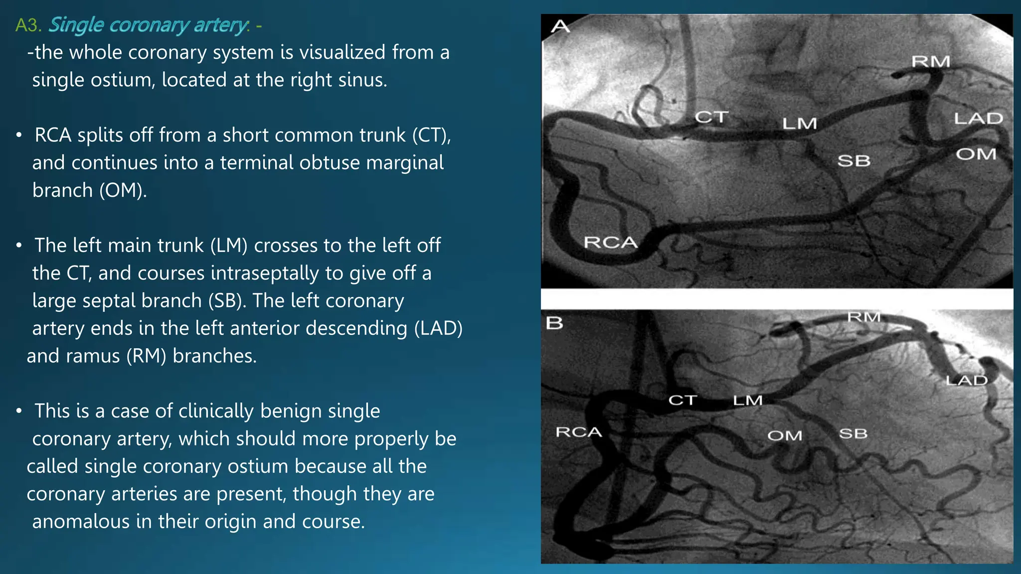 CORONARY ARTERY ANOMALIES MZ. Cardiology, Spandana collection pptx | PPTX