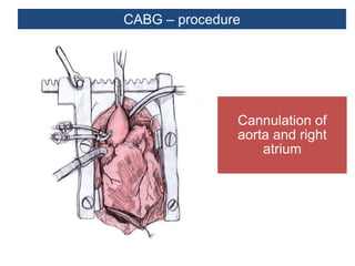 Coronary artery by pass graft | PPTX