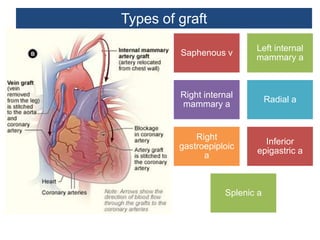Coronary artery by pass graft | PPTX