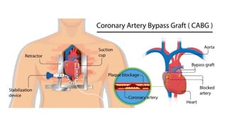 Coronary Artery Bypass Graft (CABG).pptx