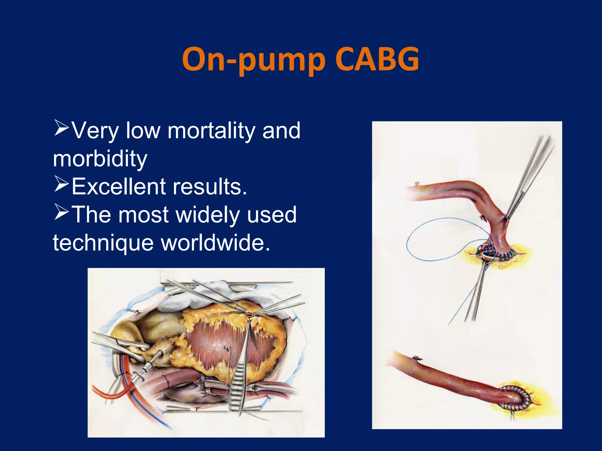 Coronary Artery Bypass Graft (CABG) Surgery | PPT